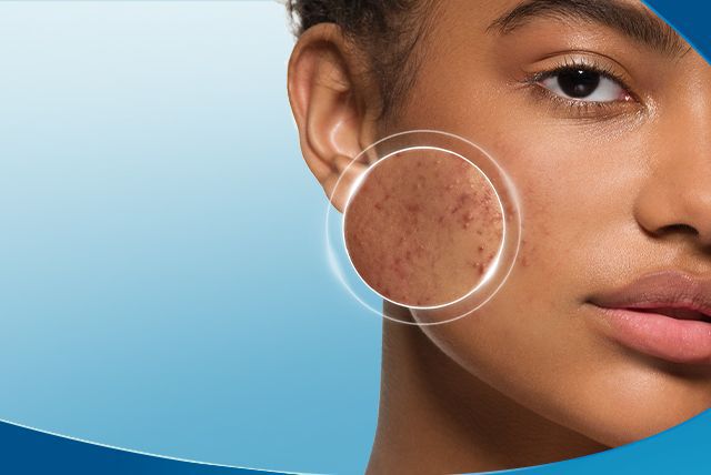 Skin Care for Acne Prone Skin | Cetaphil Australia